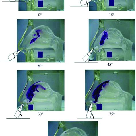 The Mucosal Atomizer Device Mad Used To Deliver Medications Via A