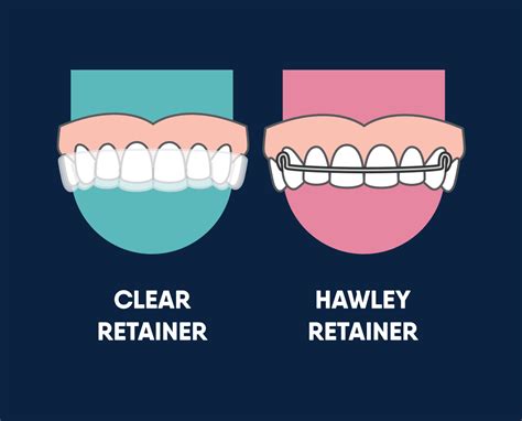 Why Do You Need A Retainer After Braces Motto Aligners