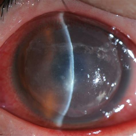 Slit Lamp Examination Shows Marked Presence Of Stromal Infiltrates