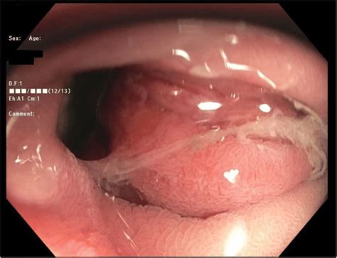 Egd Of The Duodenum Reveals A Congested Mucosa With Luminal Narrowing Download Scientific Diagram