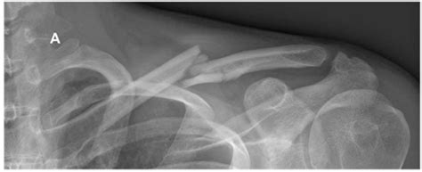 Nonoperative Treatment Of Midshaft Clavicle Fractures In Adults