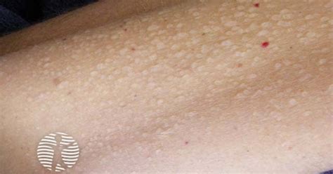 Linear Iga Bullous Disease Image