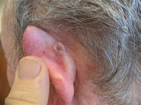 Getting To Know Skin Cancer On The Ear Flash Uganda Media