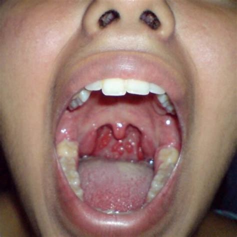 Pharyngitis Bayya Hospitals