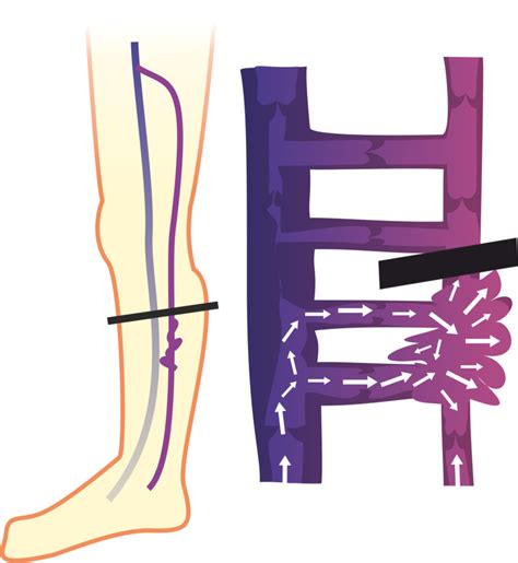 Perthes Test Wikilectures