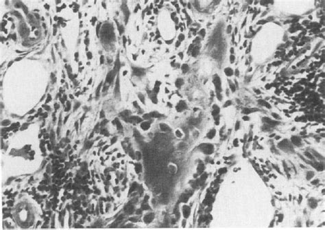 Microscopic Osteoid Osteoma Tissue Sample Magnification X 625 Stain