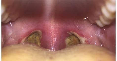 Tonsillectomy New
