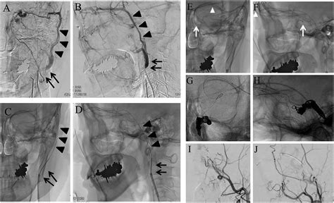 Superficial Middle Temporal Vein As A Pivotal Route To Embolize Dural