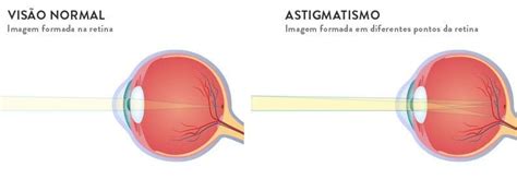 Lentes Para Miopia E Astigmatismo Qual é A Melhor Opção Lenscope