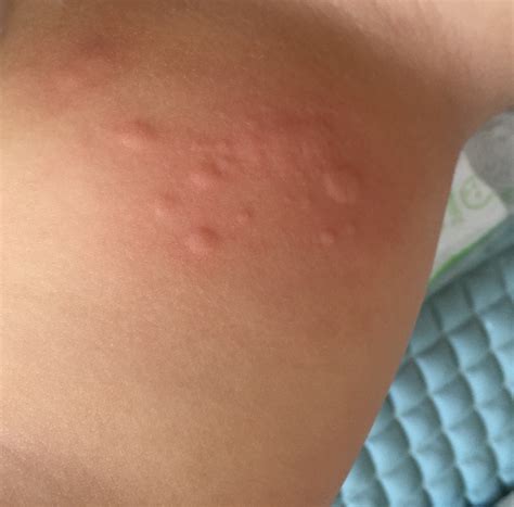 What Does Dust Mite Allergy Look Like