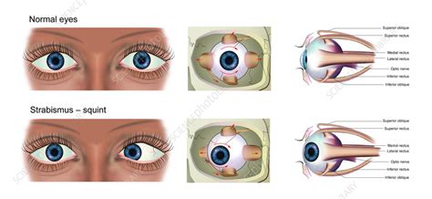 Normal Eye And Strabismus Illustration Stock Image C057 3945 Science Photo Library