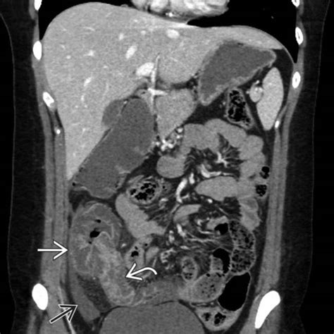 Neutropenic Colitis Typhlitis Radiology Key