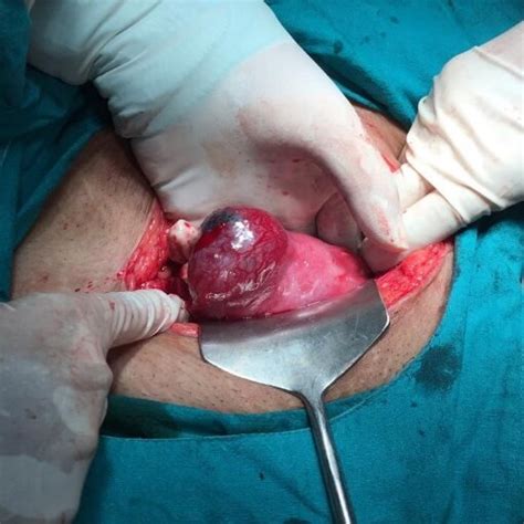 Shows Ultrasound Findings Of Cervical Ectopic Pregnancy Download