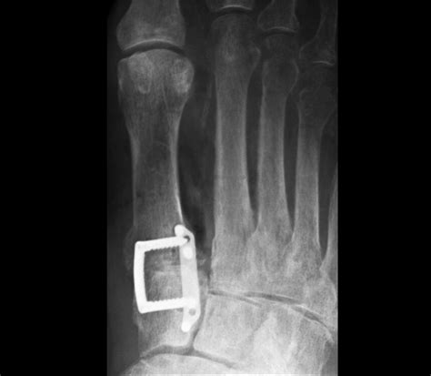 Lapiplasty® Speedplate® Treace