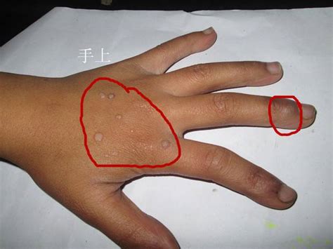 手指长疣怎么办（小心脸上手上的凸疣，有什么治猴子的简单又实用的妙方？） 说明书网