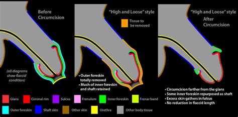 Circumcision In Istanbul Signature Aesthetica 30 Min