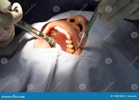 Anesthesia For Tooth Extraction By The Dentist Dentistry In Hospital