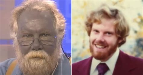 La Extraña Condición Médica Que Sufrió Paul Karason Conocido Como
