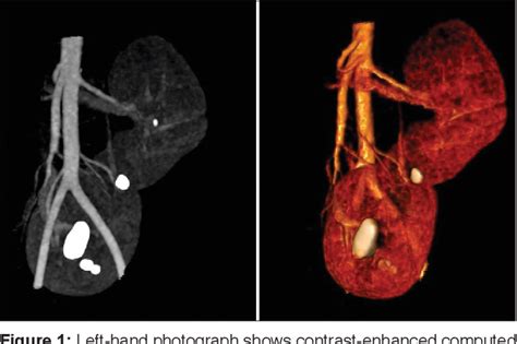 Figure 1 From Renal Stone In Crossed Fused Renal Ectopia And Its