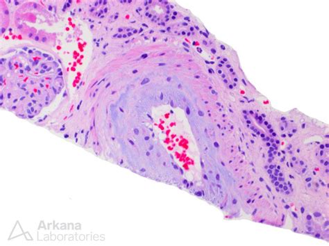 Scleroderma Diagnose This Arkana Laboratories