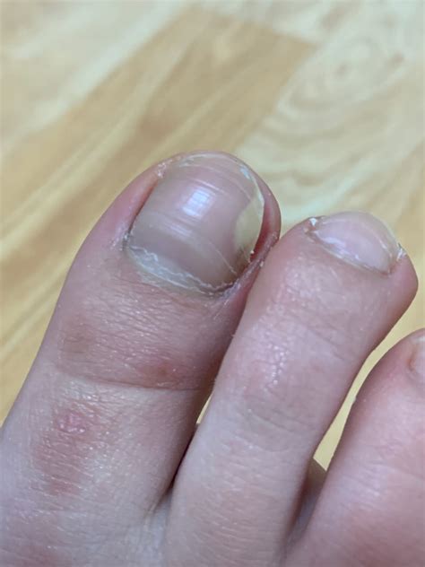 엄지발톱 무좀 지식in