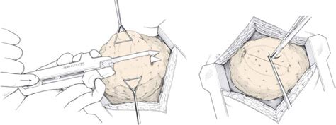 Lung Trachea And Esophagus Thoracic Key