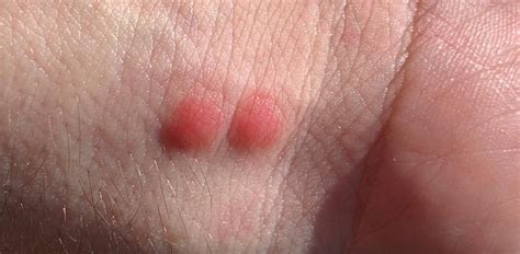 Mosquito Bites On Forehead