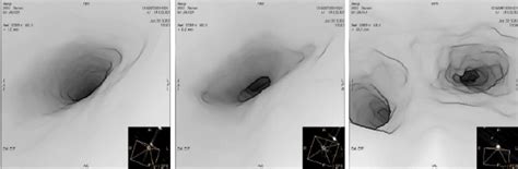 Endoluminal Visualization Of A 3 D Tomographic Reconstruction Of