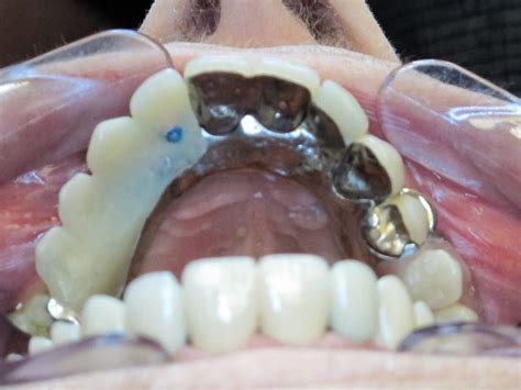 Precision Attachment Partial Dentures Dr Andrew Willoughby