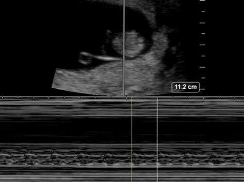 Subchorionic Bleed 10 Week Pregnancy Critical Care Sonography