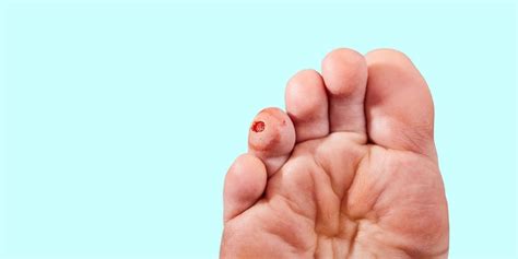 Wart Treatment Reimagined Wart Removal Injections 1aesthetics