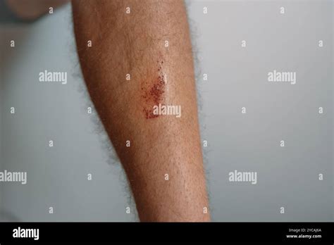 Scratch Marks On Skin Surface Cause By Sharp Fingernails Scratching An