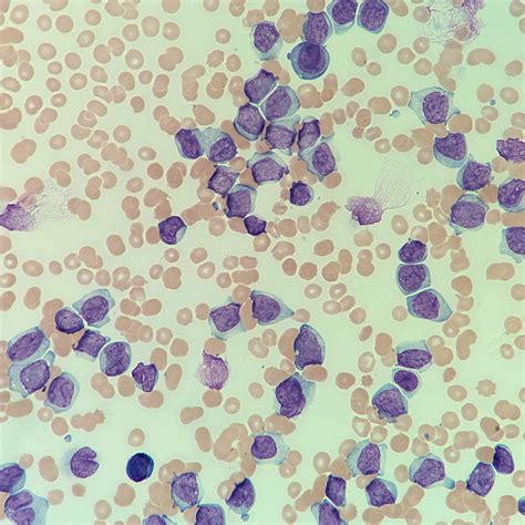 Blast Cells Identification And Differentiation