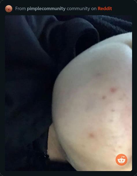 How Do I Deal With This Blackheads Random Dots And Small Pimples R