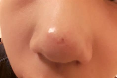 Blackheads After Extraction