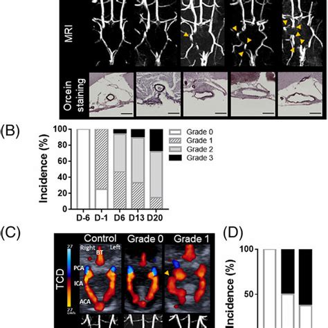 Increased Arterial Tortuosity Detected By Tcd Imaging And Confirmed By