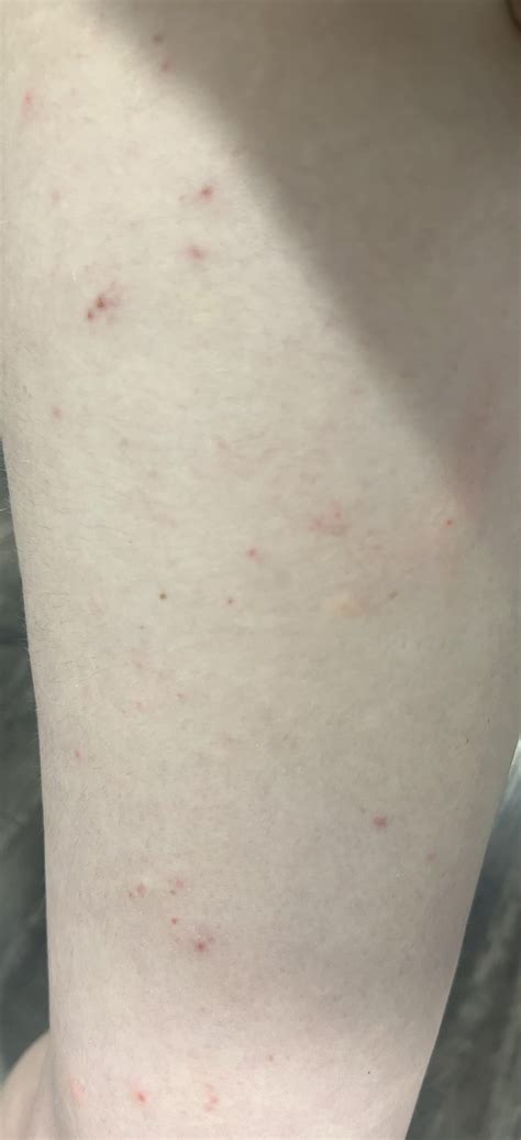Scabies And Dermatitis Or Just Dermatitis Rscabies