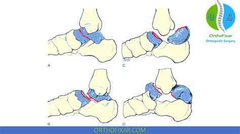 Talar Fractures And Dislocation Orthofixar 2025