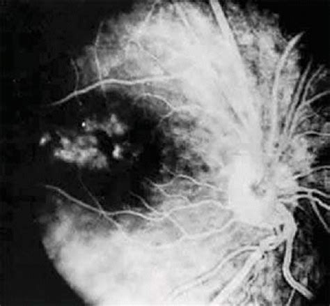 Intermediate Uveitis Ento Key