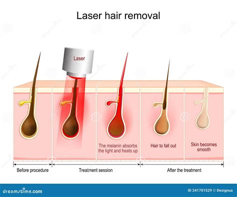 Laser Hair Removal Stock Vector Illustration Of Diagram 241701529