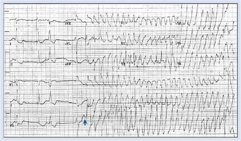 Electrocardiogram Demonstrating A Short Long Short Sequence Followed By