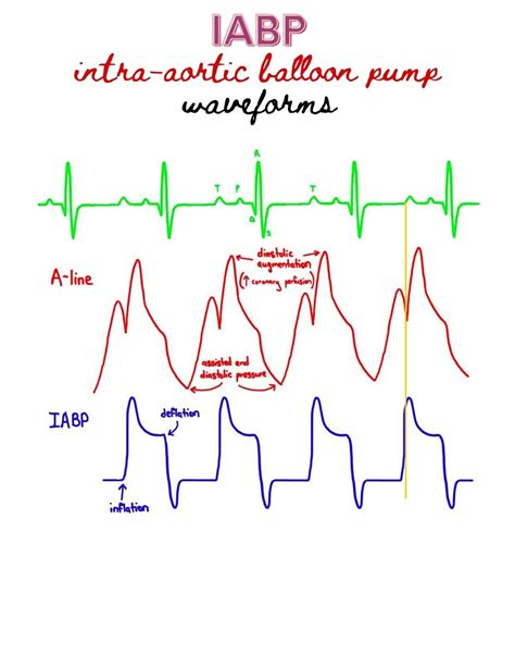Iabp Cheat Sheet Icu Nursing Notes Pdf Download Etsy