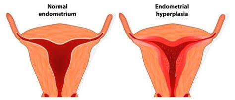 Endometrial Hyperplasia Symptoms And Treatment