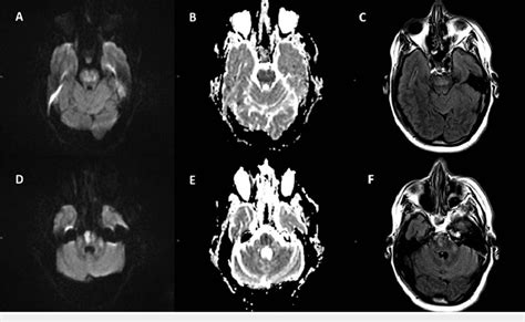 Axial Diffusion Weighted Imaging B1000 Demonstrating Restricted Download Scientific Diagram