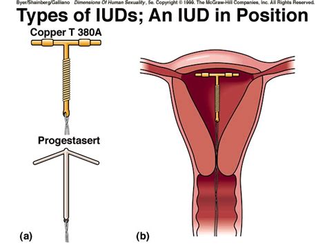 Teen Mom NYC IUD Removal Symptoms