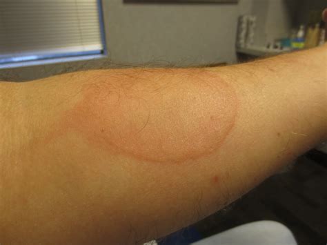 Cold Urticaria Ice Cube Test