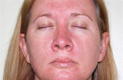 Photodermatitis Images Symptoms And Pictures