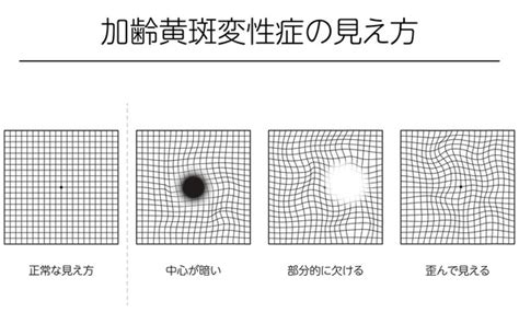 Amsler Grid Macular Degeneration
