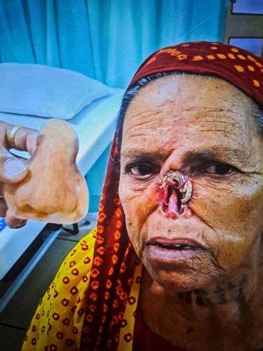 Silicone Nose Prosthesis At ₹ 20000 Ahmedabad Id 2853905156930