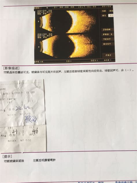 左眼碱化学烧伤